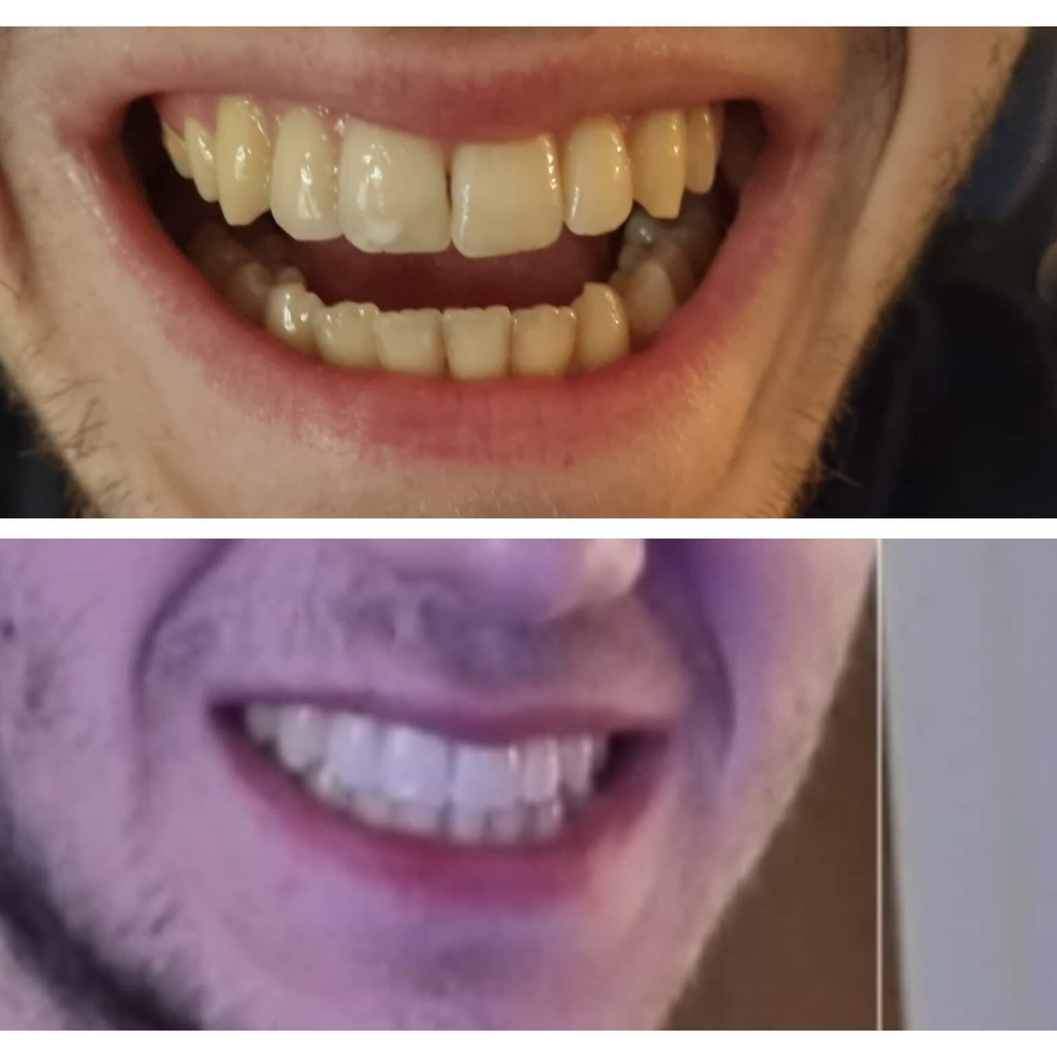 brighter smiles mobile teeth whitening - Nextdoor